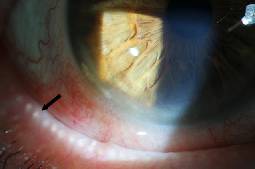 Augenbeteiligung bei atopischer Dermatitis | SpringerLink