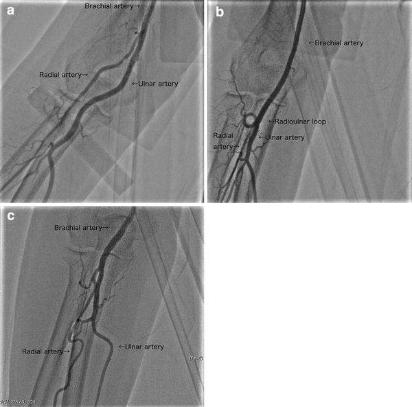 Anatomical variations affect radial artery spasm and procedural ...