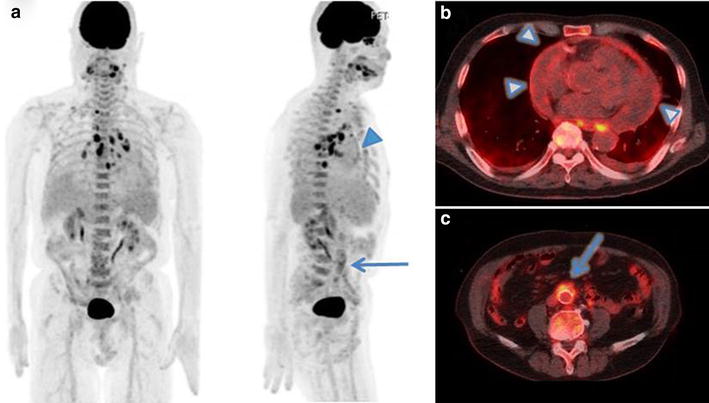 A case of IgG4-related lymphadenopathy, pericarditis, coronary artery ...