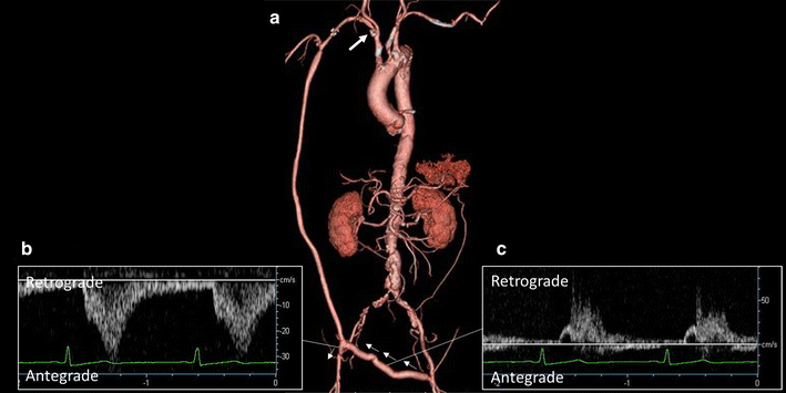 Axillo-femoral bypass steal due to subclavian artery stenosis ...