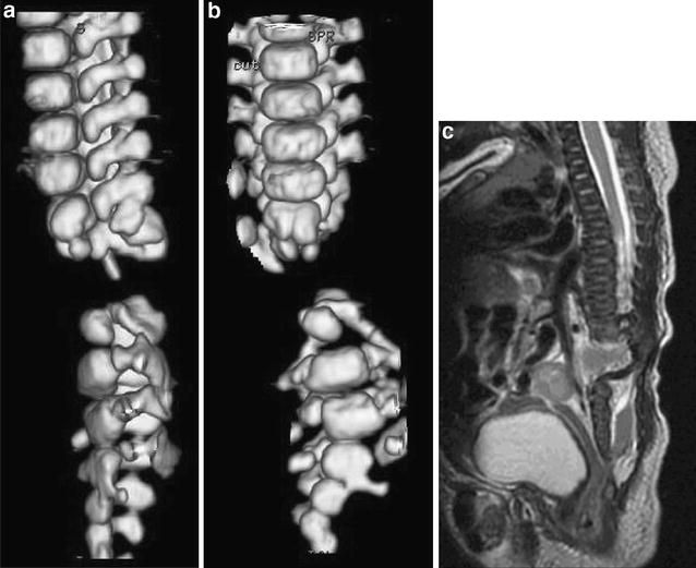 Segmental spinal dysgenesis: report of four cases and proposed ...