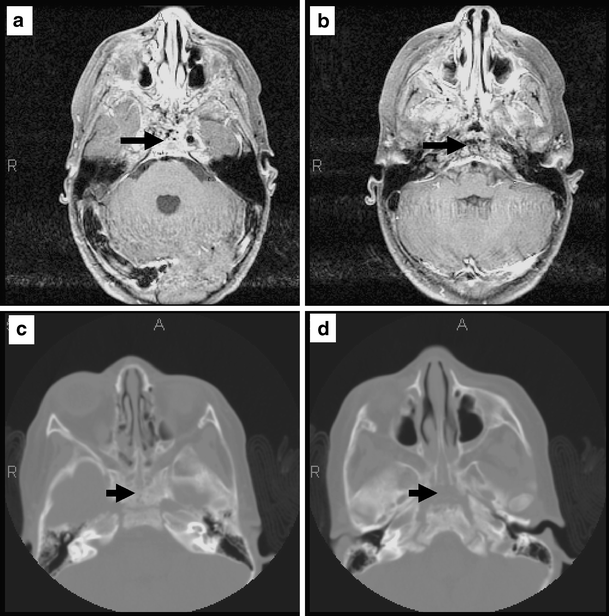 Expanded endonasal approach: a fully endoscopic completely transnasal ...