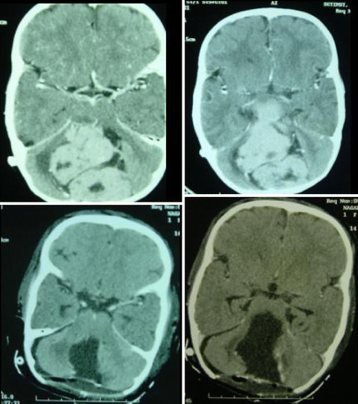 Telovelar approach: technical issues for large fourth ventricle tumors ...