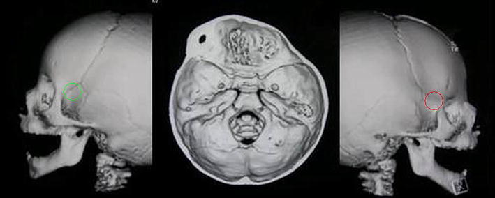 Frontosphenoidal synostosis: a rare cause of unilateral anterior ...