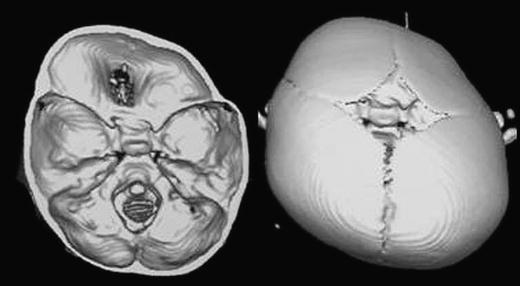 Frontosphenoidal synostosis: a rare cause of unilateral anterior ...