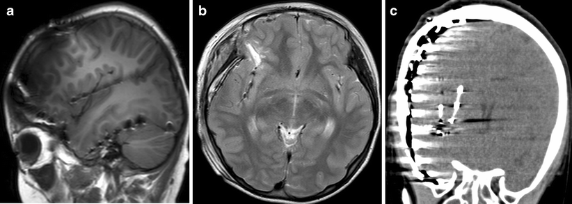 Insular epilepsy surgery under neuronavigation guidance using depth ...