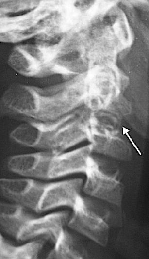 Pediatric intervertebral disk calcification in childhood: three case ...