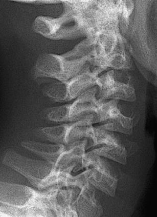Pediatric intervertebral disk calcification in childhood: three case ...