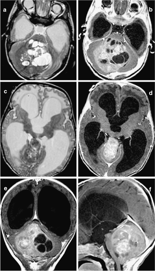 Imaging of ependymomas: MRI and CT | SpringerLink