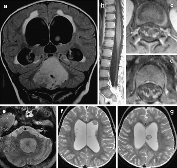 Imaging of ependymomas: MRI and CT | SpringerLink