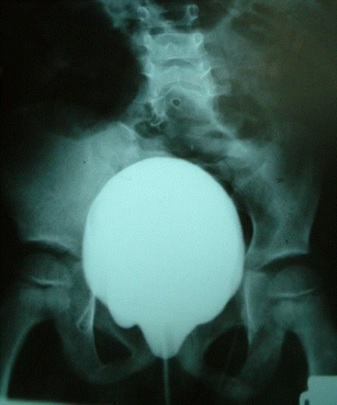 Dermal sinus tract of the spine | SpringerLink