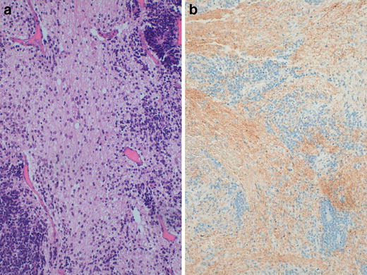 Embryonal tumor with abundant neuropil and true rosettes (ETANTR): a ...