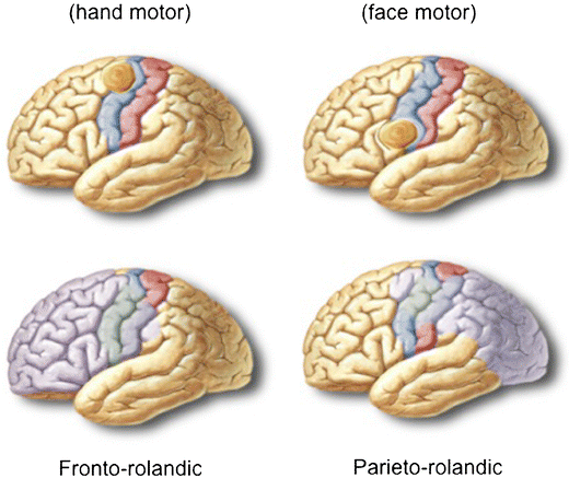 Tailored resections for intractable rolandic cortex epilepsy in ...