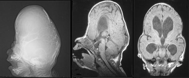 Cloverleaf skull deformity and hydrocephalus | SpringerLink