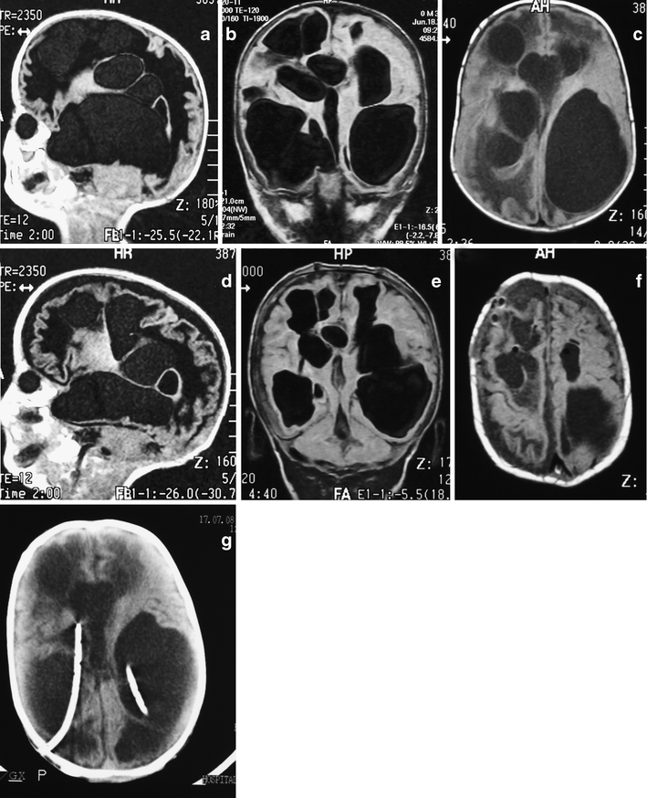 Multiloculated hydrocephalus | SpringerLink