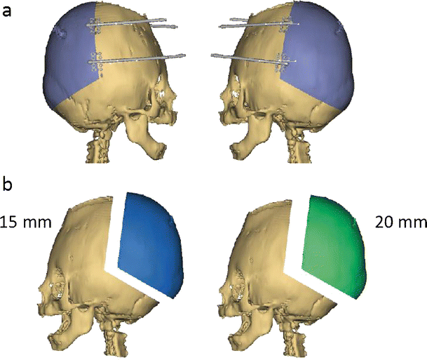 Posterior cranial vault expansion performed with rapid distraction and ...