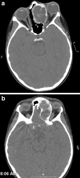 Aneurysmal bone cyst within fibrous dysplasia of the anterior skull ...