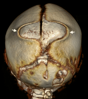 Large parietal midline defect with unusual ridge-like structure at the ...
