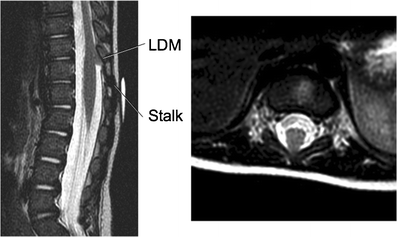 Limited dorsal myeloschisis: a not-so-rare form of primary neurulation ...