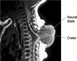 Limited dorsal myeloschisis: a not-so-rare form of primary neurulation ...
