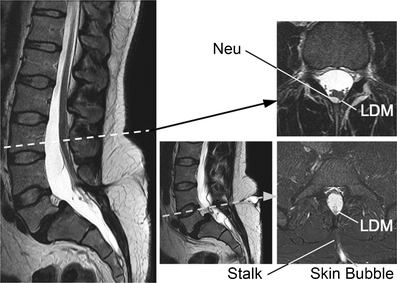 Limited dorsal myeloschisis: a not-so-rare form of primary neurulation ...
