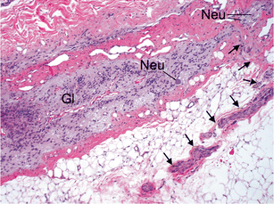 Limited dorsal myeloschisis: a not-so-rare form of primary neurulation ...