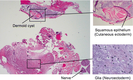 Limited dorsal myeloschisis: a not-so-rare form of primary neurulation ...