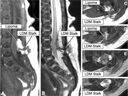 Limited dorsal myeloschisis: a not-so-rare form of primary neurulation ...