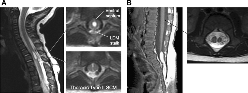 Limited dorsal myeloschisis: a not-so-rare form of primary neurulation ...