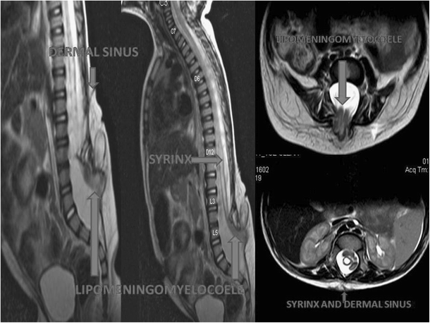 A rare case of split pons with double encephalocoele, dermal sinus ...