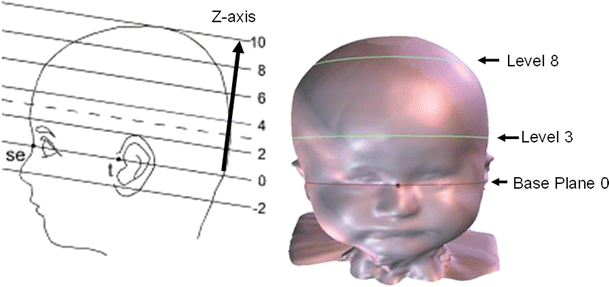 Cranial molding helmet therapy and establishment of practical criteria ...