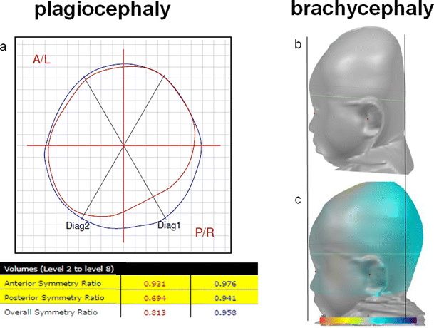 Cranial molding helmet therapy and establishment of practical criteria ...