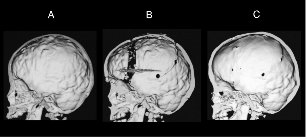 One-piece bone flap osteotomy using thread wire saw for fronto-orbital ...