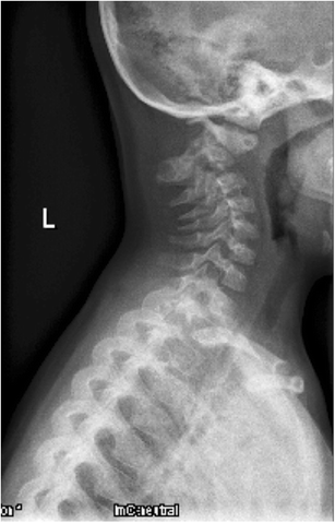 The odontoid process: a comprehensive review of its anatomy, embryology ...