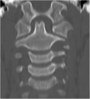 The odontoid process: a comprehensive review of its anatomy, embryology ...