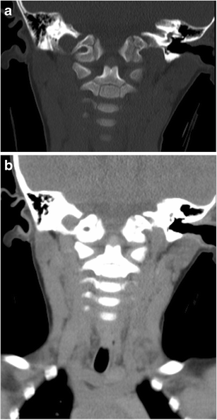 The odontoid process: a comprehensive review of its anatomy, embryology ...