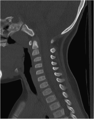 The odontoid process: a comprehensive review of its anatomy, embryology ...