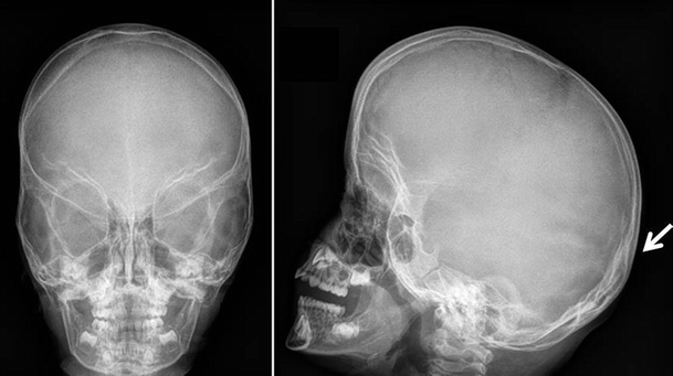 Diagnostic features of prematurely fused cranial sutures on plain skull ...