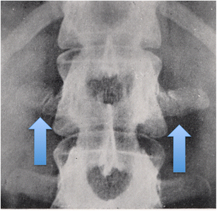 Lumbar ribs: a comprehensive review | SpringerLink