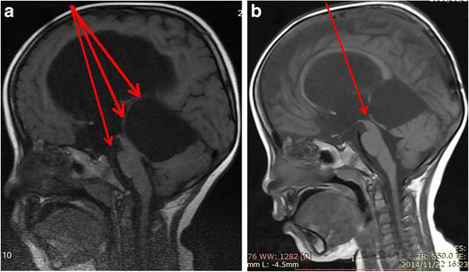 Assessment of endoscopic treatment for quadrigeminal cistern arachnoid ...