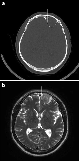 Secondary adult encephalocele with abscess formation of calcified ...