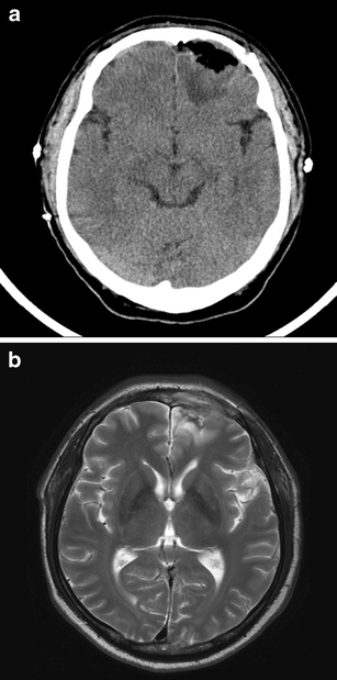 Secondary adult encephalocele with abscess formation of calcified ...
