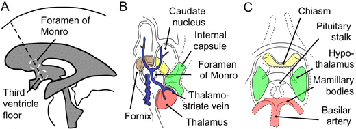 Operative Planning Aid For Optimal Endoscopic Third Ventriculostomy