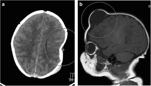 Craniocerebral birth injuries in term newborn infants: a retrospective ...