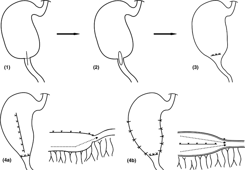 Novel procedures for enhancing high jejunal atresia repair: bilateral ...