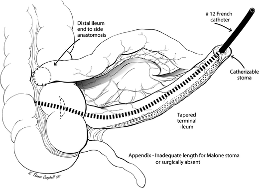 Tapered terminal ileum conduit for antegrade continence enemas ...