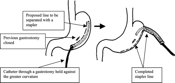Revision of prolapsed feeding gastrostomy with a modified Janeway ...