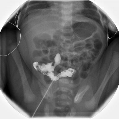 A neonate with an intact congenital umbilical appendix: an alternative ...