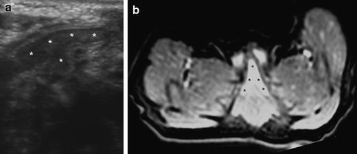 Atypical aphallia | SpringerLink