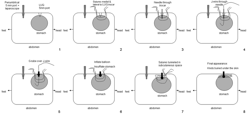 Modified approach to laparoscopic gastrostomy tube placement minimizes ...